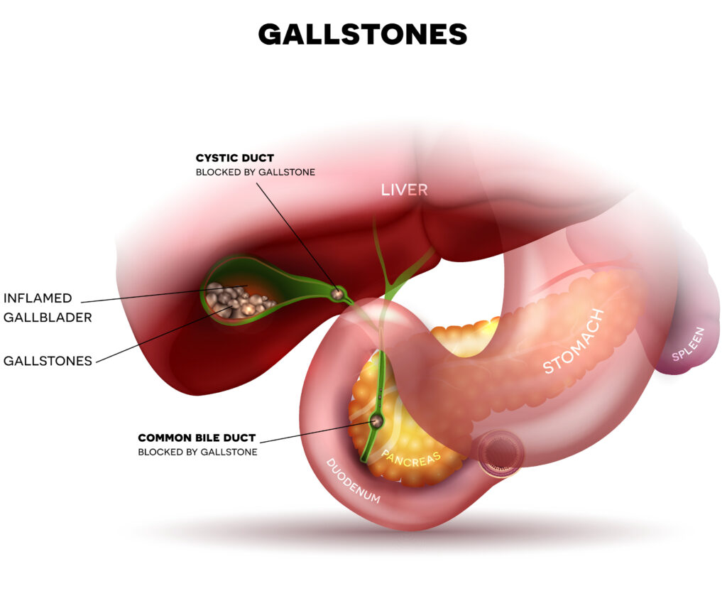 Expert Gallbladder Stone Surgery Doctors at GI-ONE Hospital in Aurangabad
